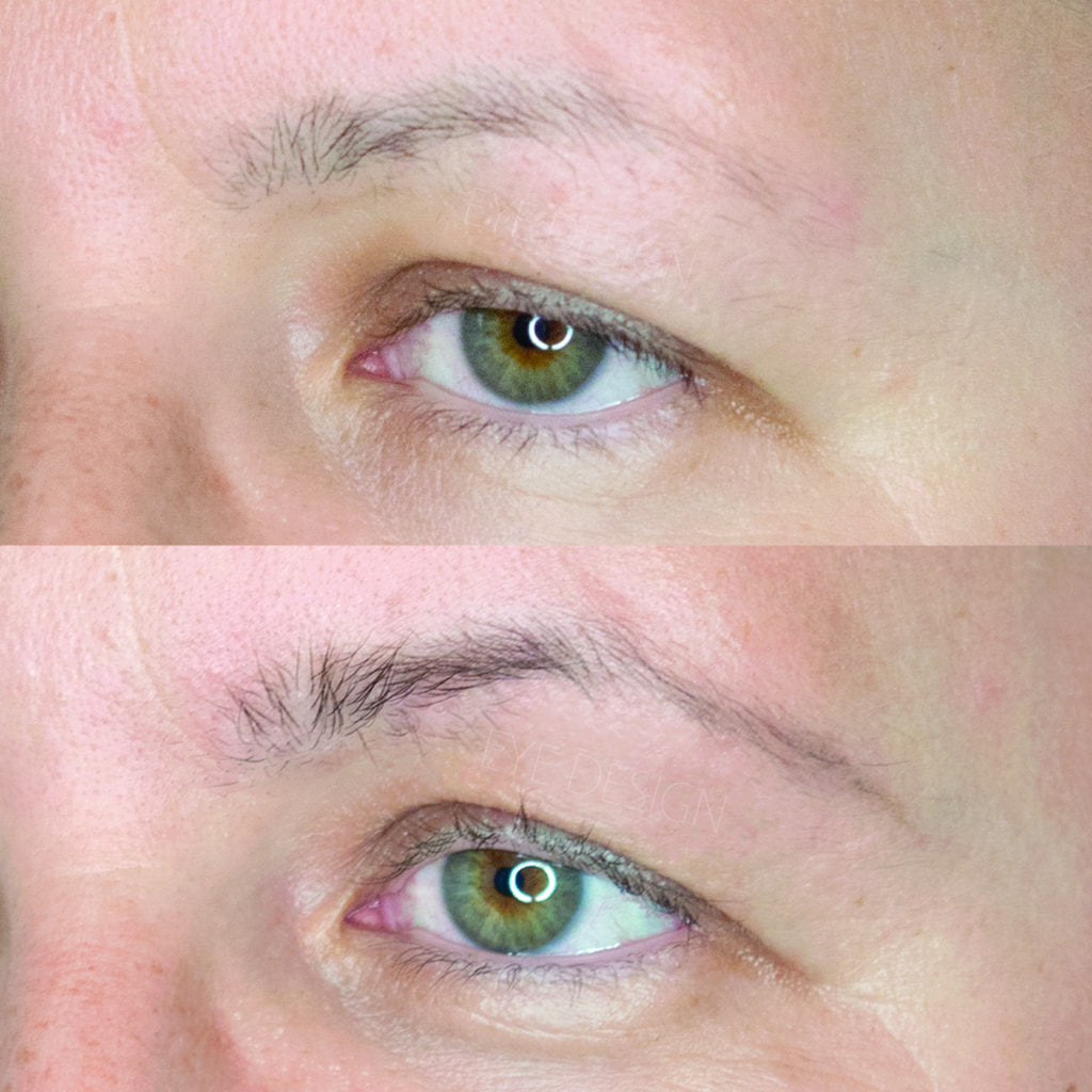 Non Surgical Eye Lift - Eye Design New York